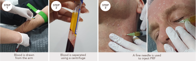 Regen PRP | PRF | Cellular Matrix - Changes Clinic, Tallaght, Dublin